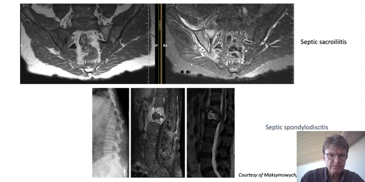 Differential diagnoses in suspected axial SpA