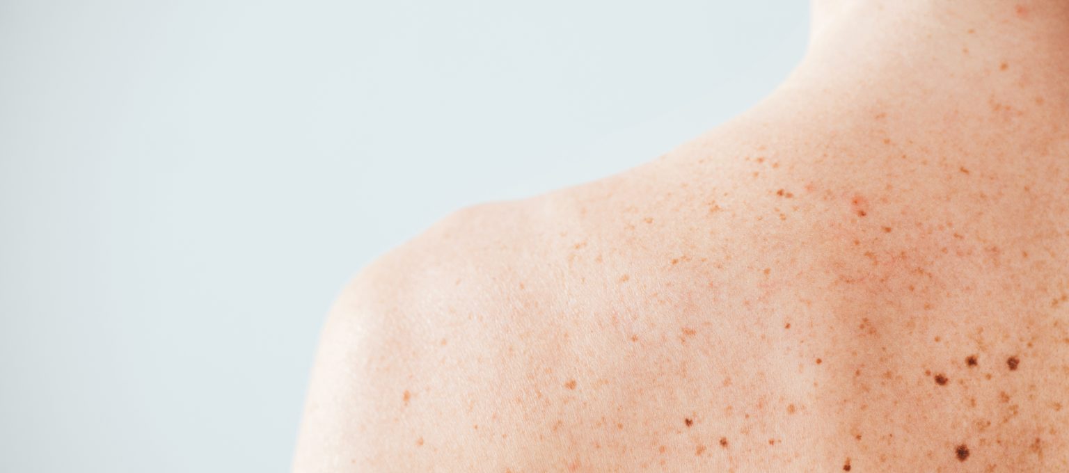 Nivolumab in combination with relatlimab significantly improved PFS in ...